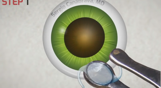 Four Flanged with AKREOS IOL (capítulo 3) – por Dr Sergio Canabrava ...